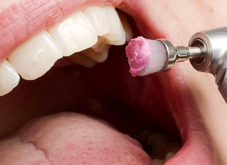 Zahnprophylaxe - Zahnarzt Dr. Bischof